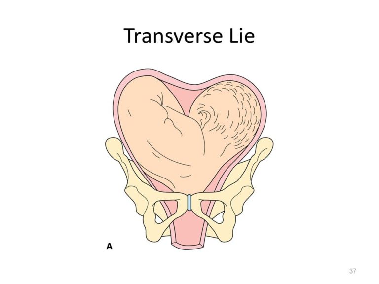 Breech | Home4Birth